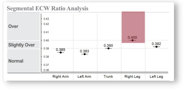 ECW Ratio: The Overlooked Health Indicator About Inflammation - InBody Asia